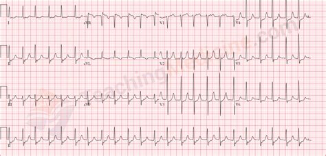 Junctional Escape Rhythm