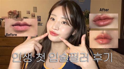 쫄보의 인생 첫 입술 필러 후기💉아말리안 필러 1cc 비대칭교정 Youtube