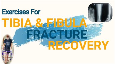 Exercise After Tibia And Fibula Fracture At Beau Eardley Wilmot Blog