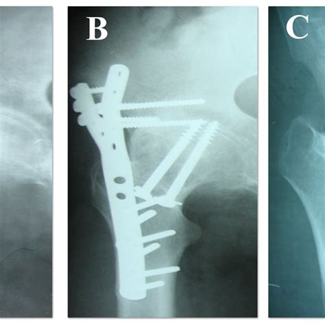 The Different Steps Of The Hip Arthrodesis Procedure With The