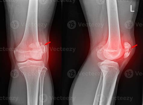 Left Knee Fracture X Ray At Helen Porter Blog