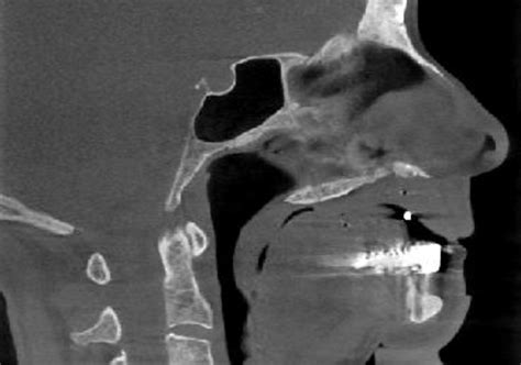 2 Cbct Scan Of The Patient Showing The Defect Download Scientific