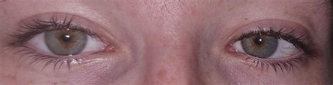 I Think I Ve Got A Bit Of A Lazy Eye R Eyes
