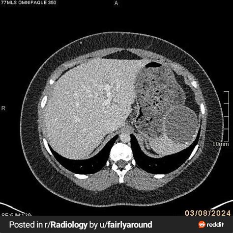 Cyst On Spleen Ct Scan Rdiagnoseme