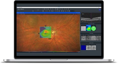 Zeiss Retina Workflow Retina Today