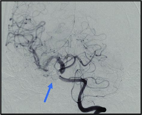 Postcoil Embolization Angiogram Of The Right Ica Shows Successful Download Scientific Diagram