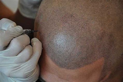 Scalp Micropigmentation Treatment In India Cost Benefits And Results