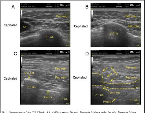 Intercostobrachial Nerve Block