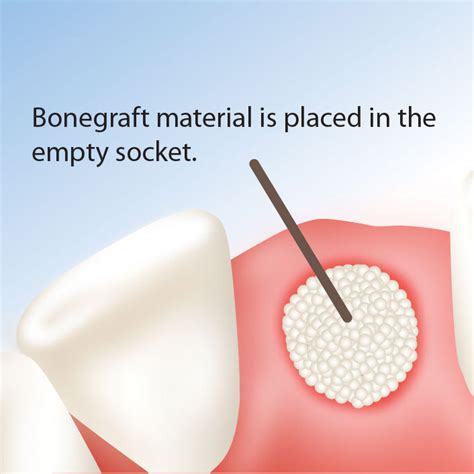 Socket Preservation Near Me Lincoln Ma 01773
