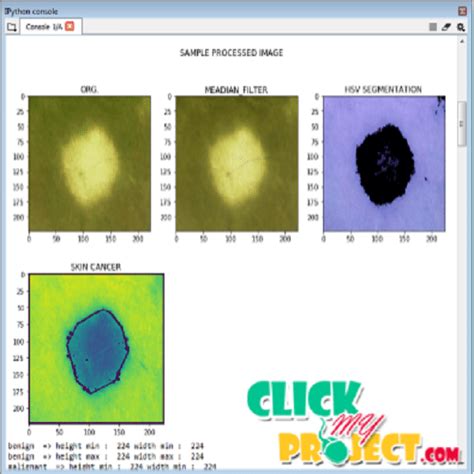 Skin Cancer Detection Using Deep Learning Clickmyproject