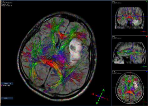 Radiology Imaging Techniques Of Brain Tumours Intechopen