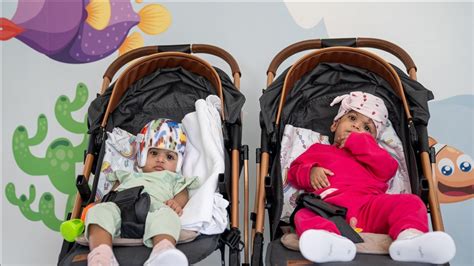 8 Month Old Conjoined Twins From Pakistan Successfully Separated In