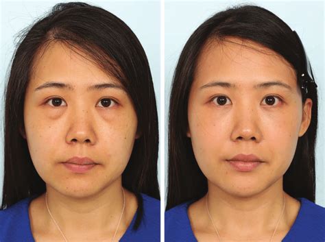 A 31 Year Old Woman Presented With Eye Bags And A Prominent Tear Trough