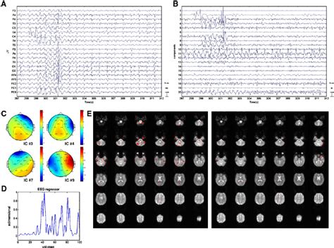 Patient 3 A Eeg Signal After Pre Processing B Eeg Components