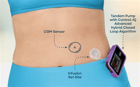 What Is An Automated Insulin Delivery System