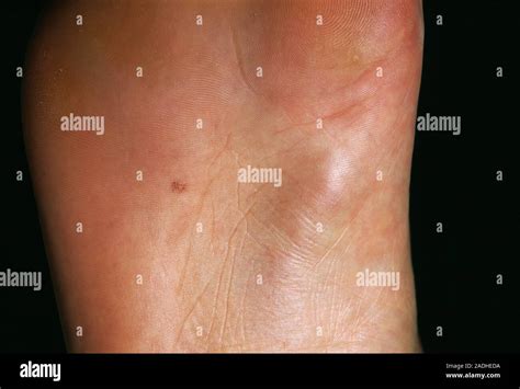 Dupuytrens Disease Sole Of A 46 Year Old Male Patients Foot Showing A Bulging Muscle Centre