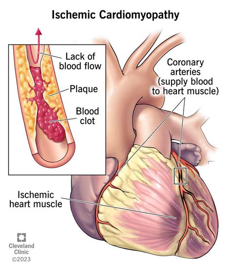 Ischemic Cardiomyopathy Symptoms Causes 51 Off