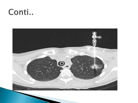 Ct Guided Lung Biopsy Pptx Lung Mass Is Malignant Cancerous Or Benign Pptx