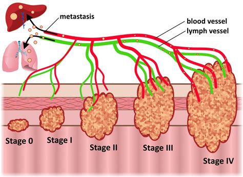 Stages Of Cancer Cоlоn Cаnсеr Screening Sooner You Should Go For It