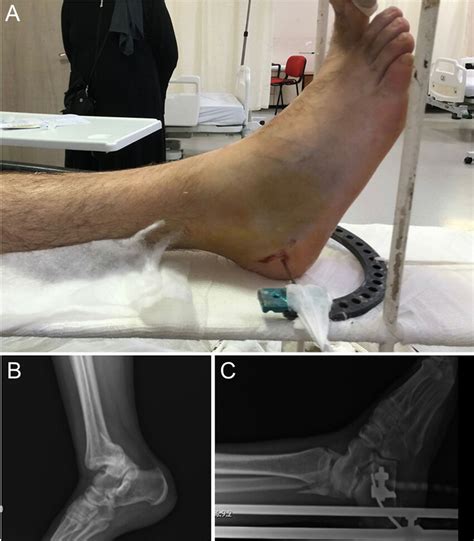 Objective Of Skeletal Traction At Martha Cannon Blog