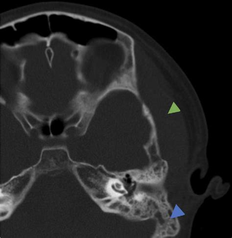 Luc Abscess Applied Radiology