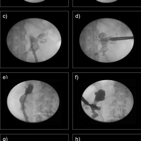 A Duplicated Collecting System With Guidewires Placed In Both Systems
