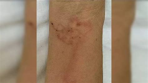 Parasitic Worms Crawl Under A Vietnamese Womans Skin After Eating