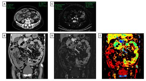 Principles And Applications Of Dual Layer Spectral Ct In Gastrointestinal Imaging