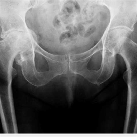 Measurement Of Radiographic Outcomes After Acetabular Reconstruction Download Scientific