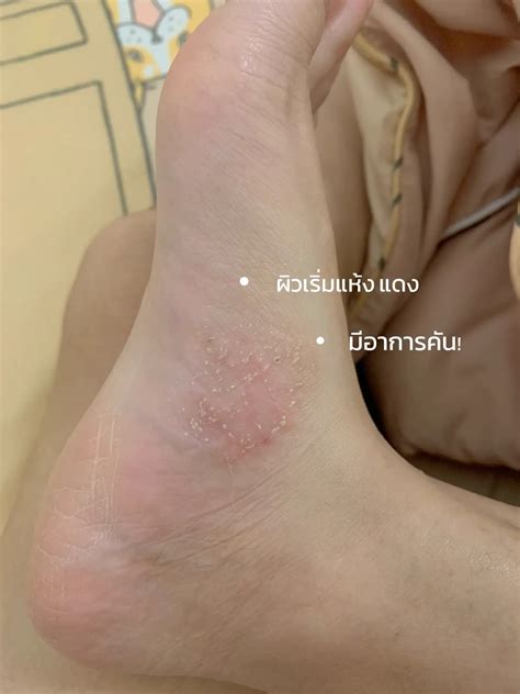 แชร์ประสบการณ์รักษาภูมิแพ้ผิวหนัง แกลเลอรีที่โพสต์โดย Preem 94♾ Lemon8