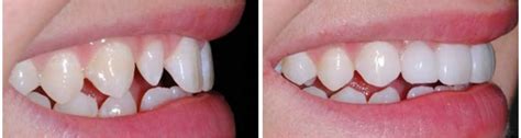 Peg Teeth Causes Treatment And Symptoms Smile Cliniq