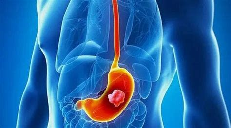 Paracentesis Is The Most Common Method In Malignant Ascites Treatment By Ben Wood Medium