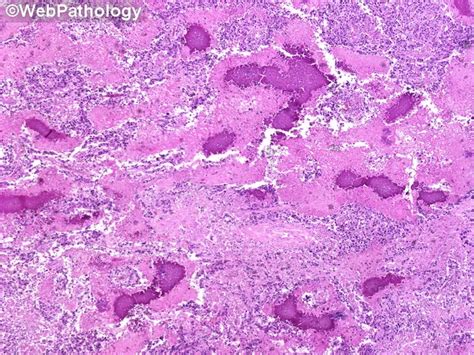 Gonadoblastoma Malignancy