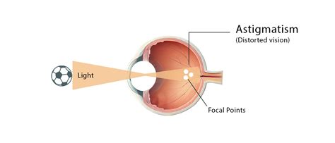 Is It Worth Correcting Astigmatism Using Lasik Surgery Euroeyes