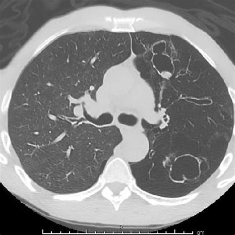 Pdf A Unilateral Hyperlucent Lung Swyer James Syndrome A Case Report And Literature Review