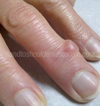 Hand To Shoulderwhat Is A Ganglion Cyst And Does It Need Treatment
