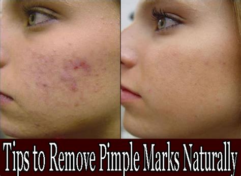 How To Remove Pimple Marks Health Villas