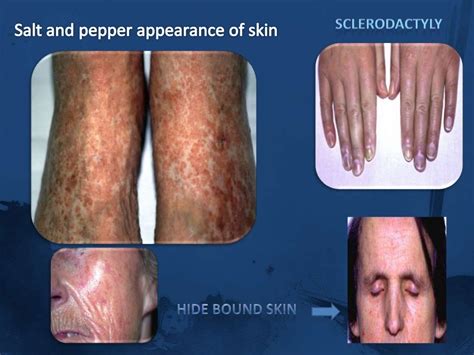 Systemic Sclerosis Scleroderma