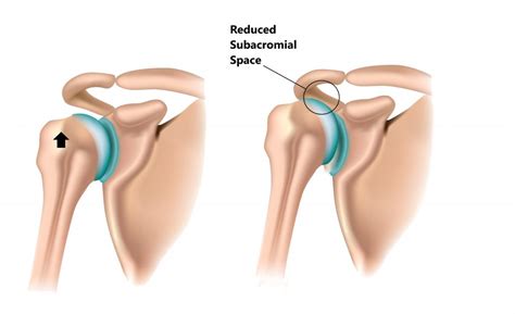 Subacromial Joint