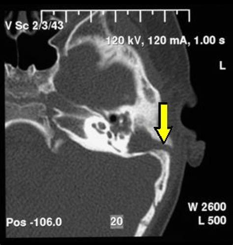 CT Scan Of Temporal Bone The Thick Arrow Shows The Bony Discontinuity Download Scientific