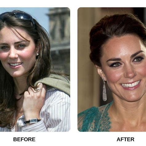 Freddie Mercury Teeth Before And After What Happened In His Transformation Dental Treatment