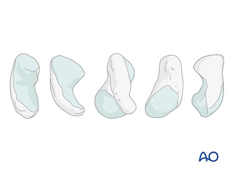 Orif Through Dorsal Approach Antegrade Screw Fixation For Scaphoid Waist Fracture