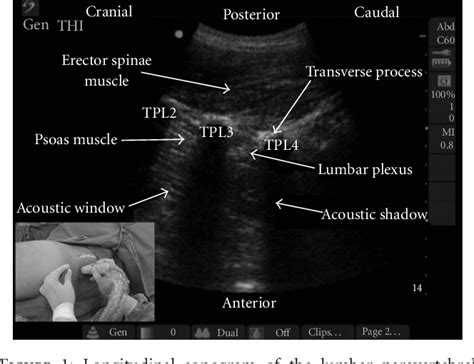 Figure 1 From The Psoas Compartment Block For Hip Surgery The Past