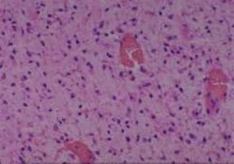 Novus Biologicals Human Multi Tissue Tissue Microarray Cancer Human