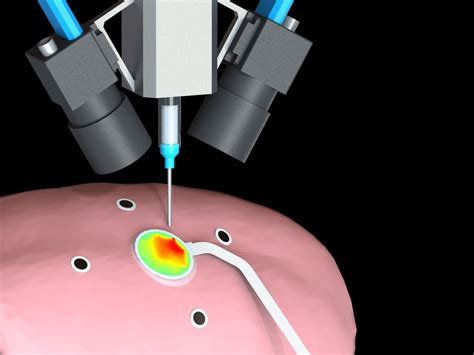 Hydrogel Sensor 3d Printed Directly Onto A Breathing Lung Regmednet