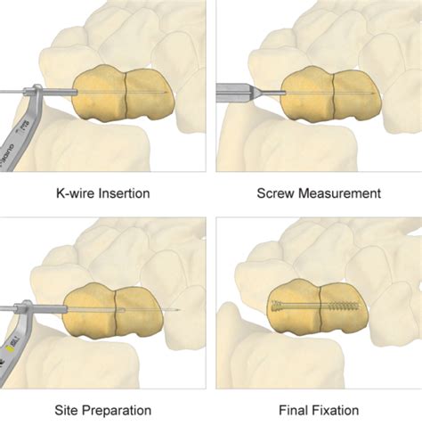 Scaphoid Screw Fracture Treatment Implant Trimed Inc Scaphoid Screw Fracture Treatment Implant Trimed Inc