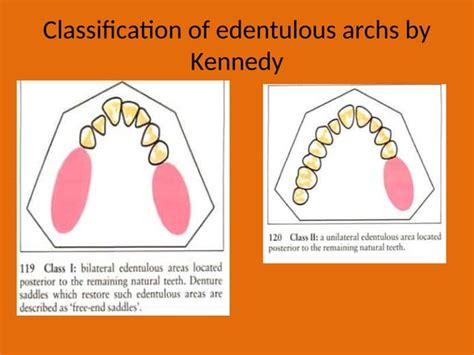 1659908partial Denture Classification Ppt