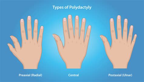 Congenital And Hereditary Diseases Mind Map