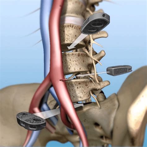 Minimally Invasive Interbody Approaches Anterior Alif Lateral Llif Download Scientific