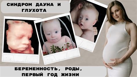 Рождение малыша с синдромом Дауна и глухотой Беременность Роды Начало пути Youtube